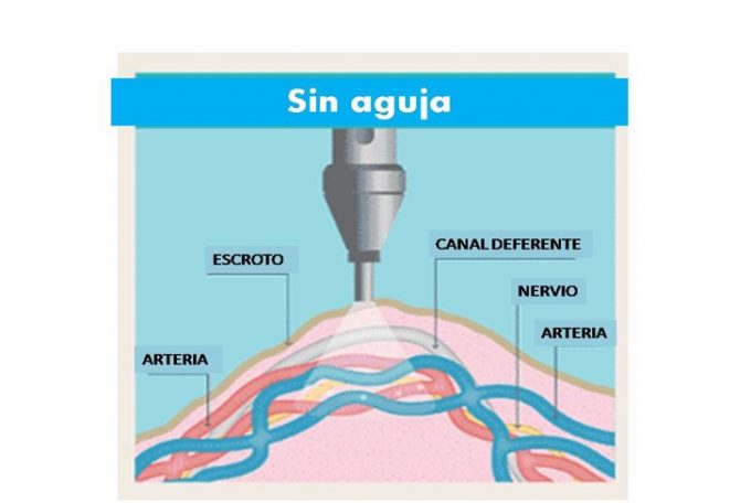 Conoce un poco más de este procedimiento y acércate a los profesionales ...